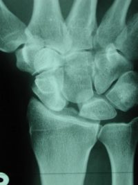 Bandverletzungen - Handchirurgie Bayern