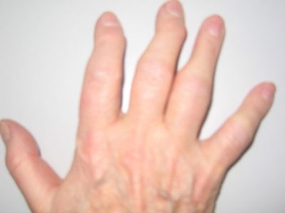 Arthrose Fingergelenke - Handchirurgie Bayern