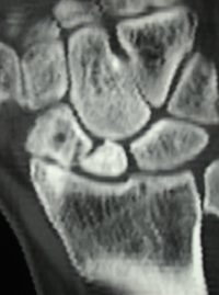 Arthrose Handgelenk - Handchirurgie Bayern