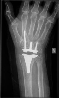 Arthrose Handgelenk - Handchirurgie Bayern