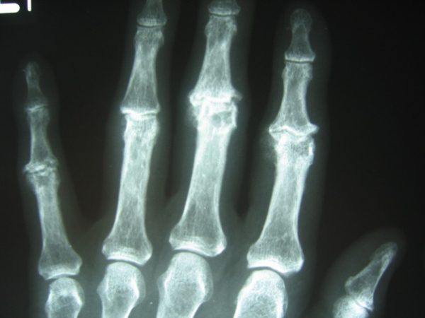 Arthrose Fingergelenke - Handchirurgie Bayern